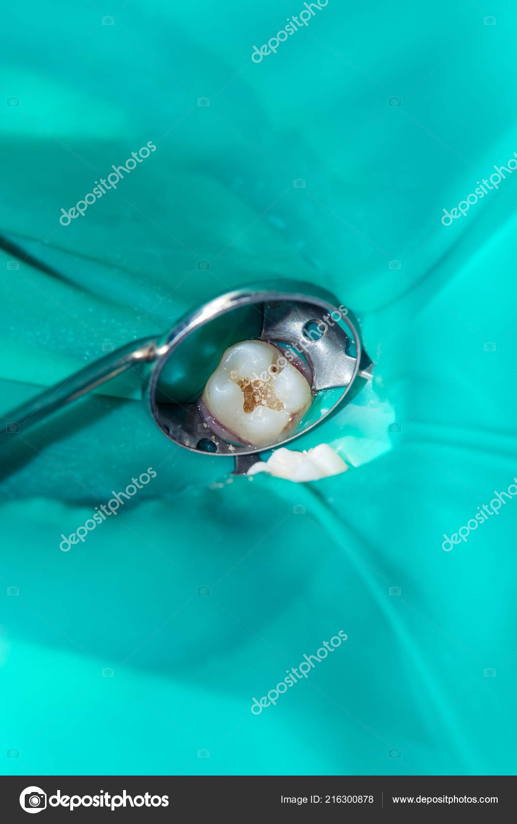 Primer Plano Diente Carioso Podrido Humano Etapa Tratamiento Una ...