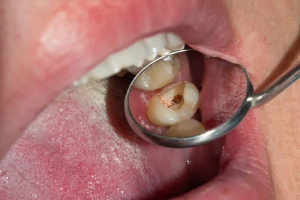 Rotten teeth Images - Search Images on Everypixel