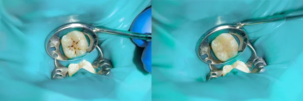 Caries removal Stock Photos, Royalty Free Caries removal Images ...