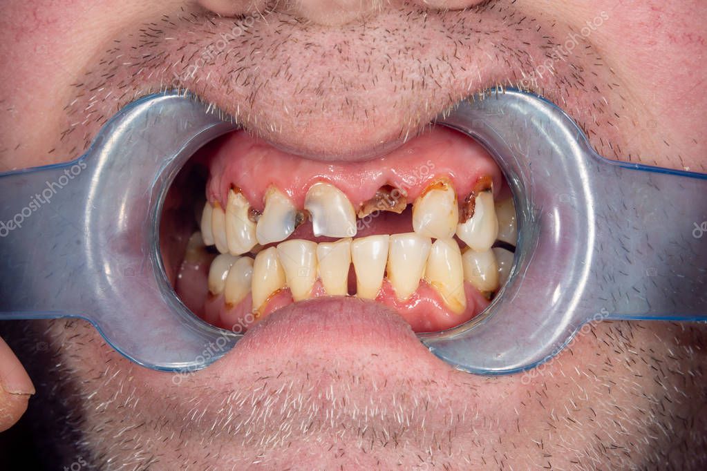 dientes podridos, caries y placa de cerca en un paciente socialmente ...