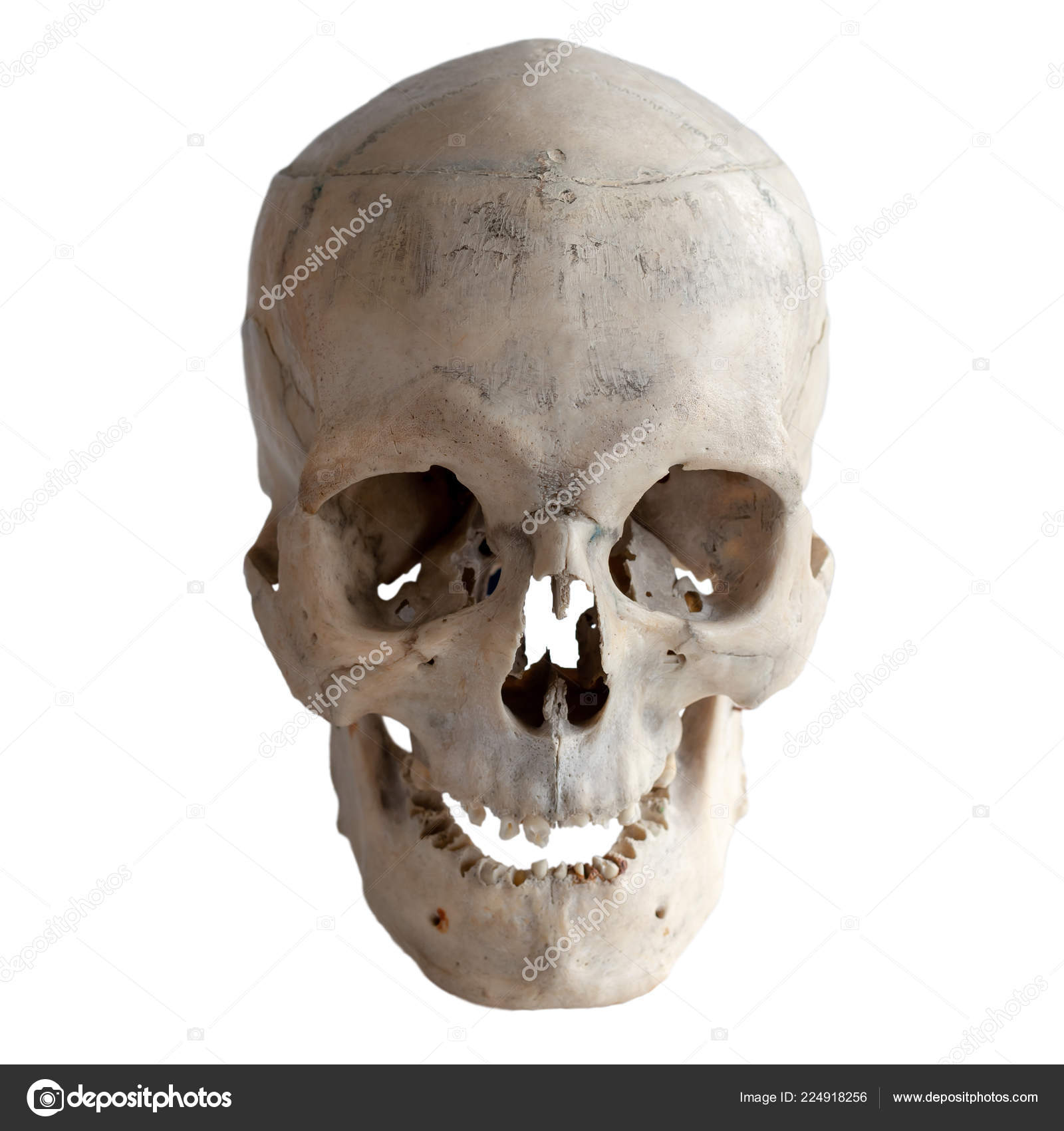 Real Human Skull Front Human Skull 150 Years Old, Apparently It Has A