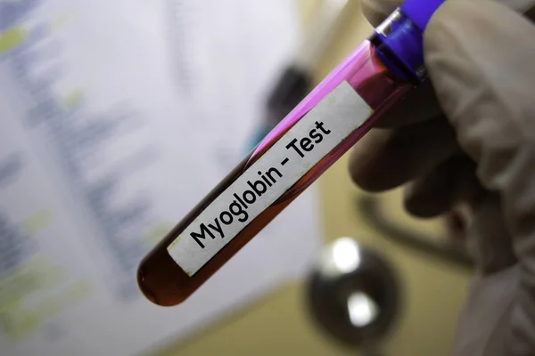 Protein C - Test with blood sample. Top view isolated on office desk ...