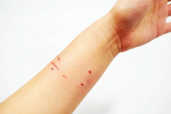 Scratch wound Stock Photos, Royalty Free Scratch wound Images ...
