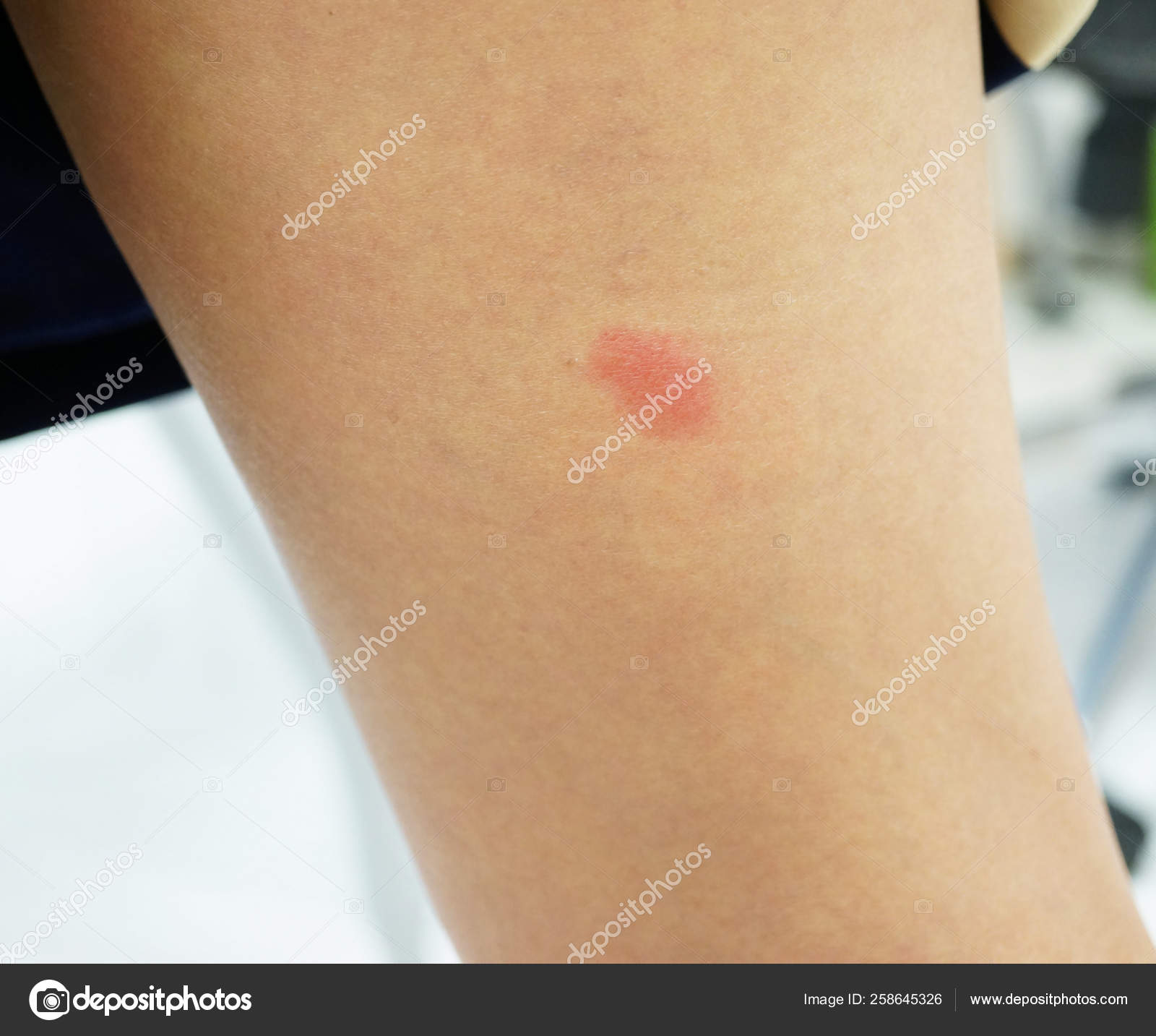 Kulit Manusia Menyajikan Reaksi Alergi Alergi Ruam Pada Lengan Wanita ...