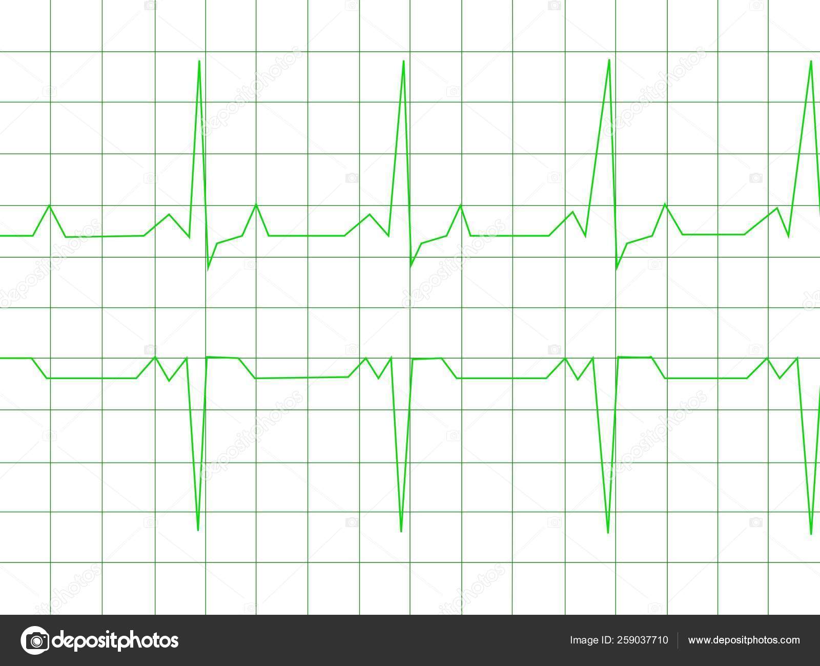 Normal Heart Rhythm Electrocardiogram Ecg Graph White Background Stock ...