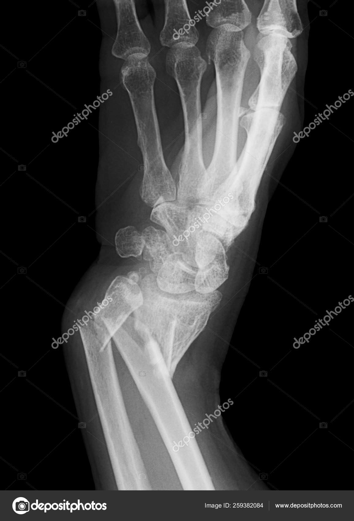 Broken Left Forearm X Ray