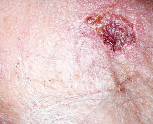 Scab Hairy Human Flesh Stock Photo by ©YAYImages 260693072