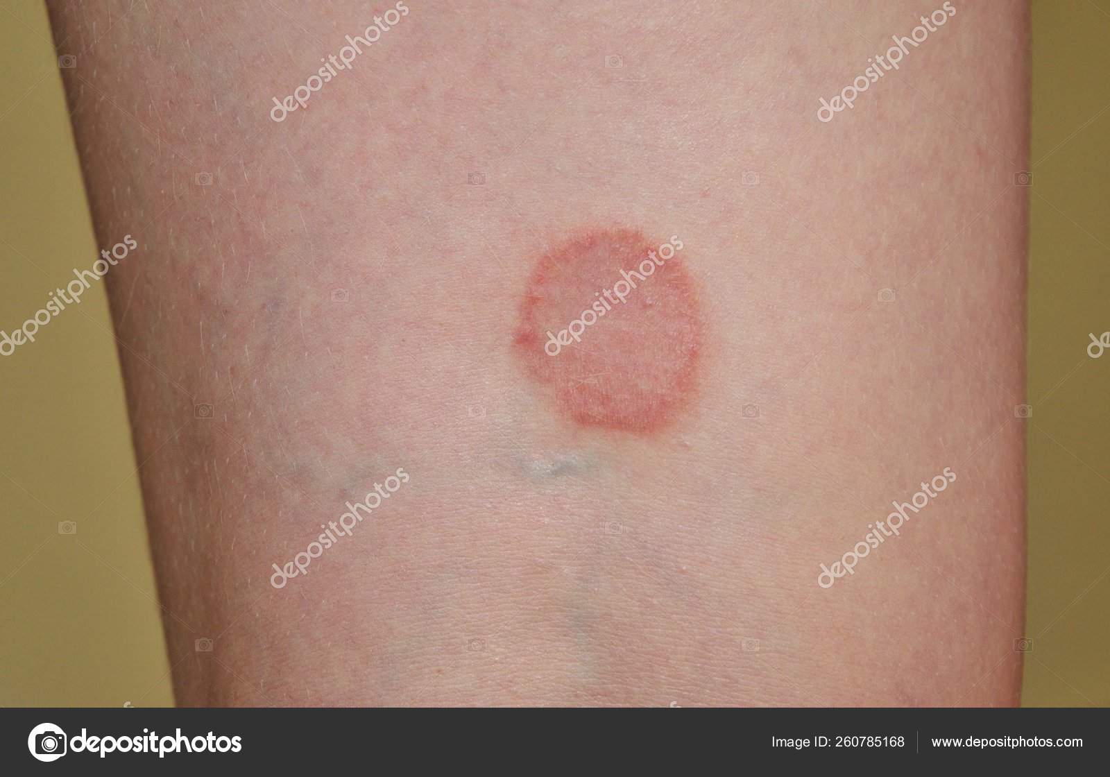 Lichen Ruber Planus Sur Jambe Jeune Femme image libre de droit par ...
