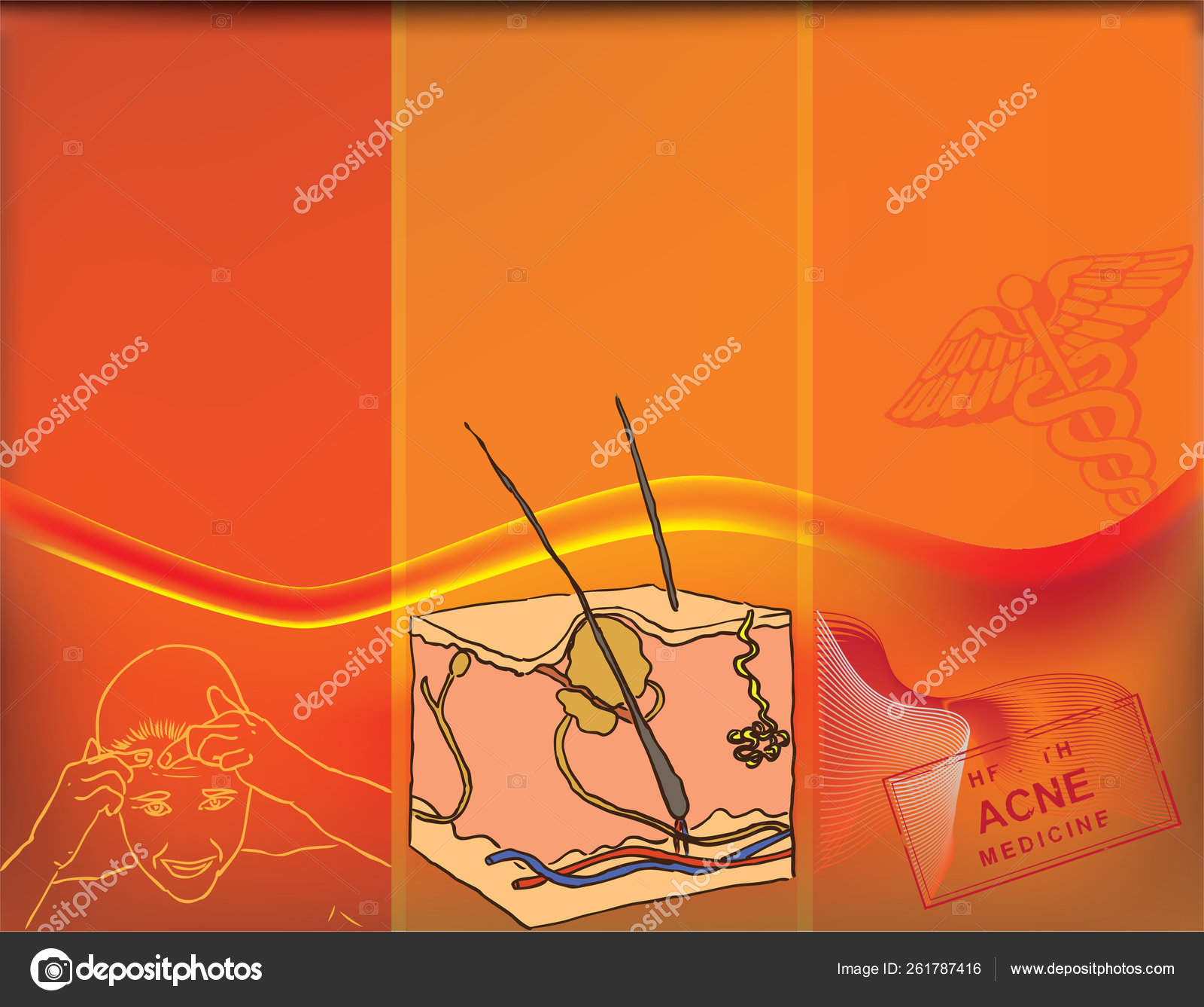 Vector Illustration Acne Disease Scheme Additional Drawings Creating ...