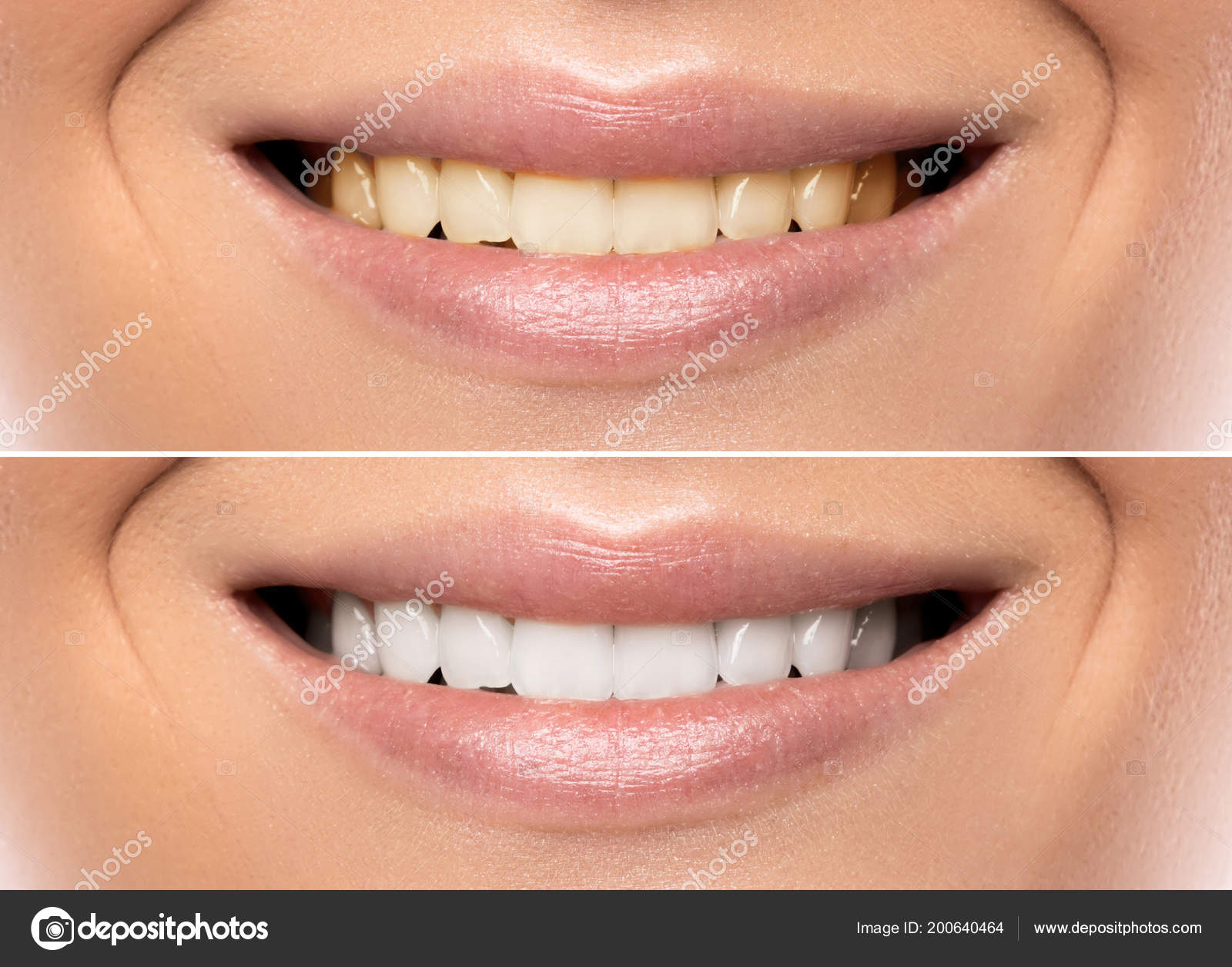 Close Female Mouth Comparison Teeth Whitening — Stock Photo © AY_PHOTO ...