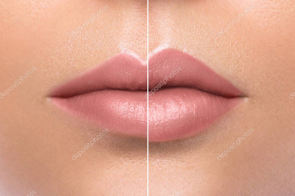Comparación de los labios femeninos antes y después del aumento 2022