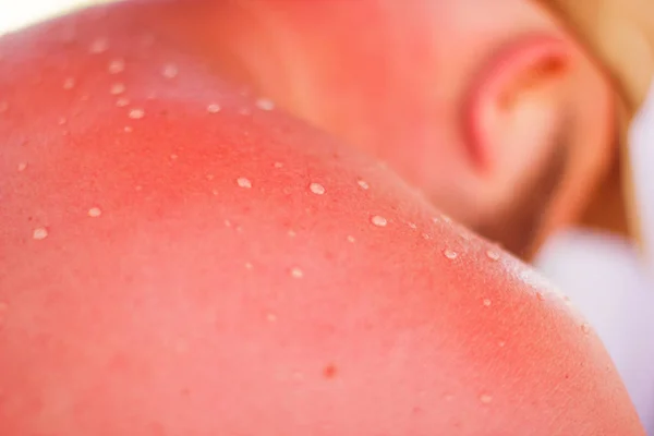 Dermatite solar Stock Photos, Royalty Free Dermatite solar Images ...