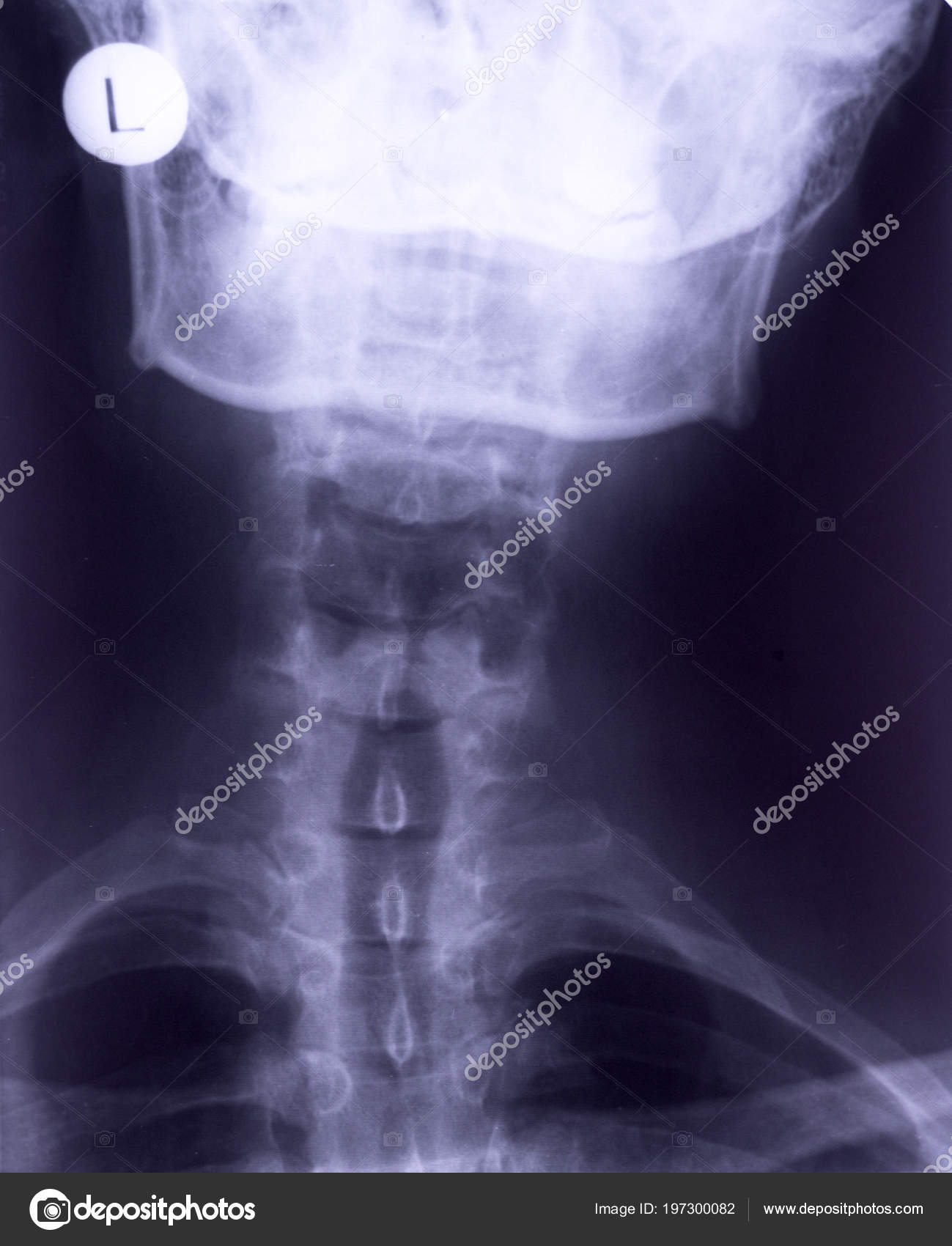 Radiografía Cuello Proyección Frontal Esguince Cervical Rectificación ...