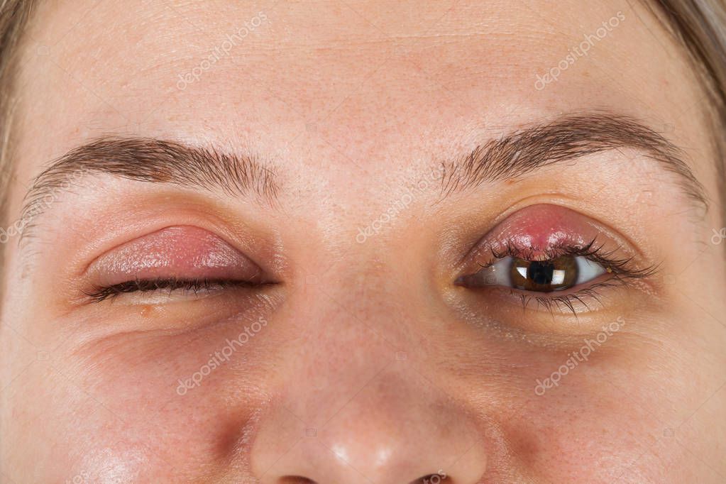 Imagen de cerca del ojo infectado de una paciente. Hordeolum en el ...