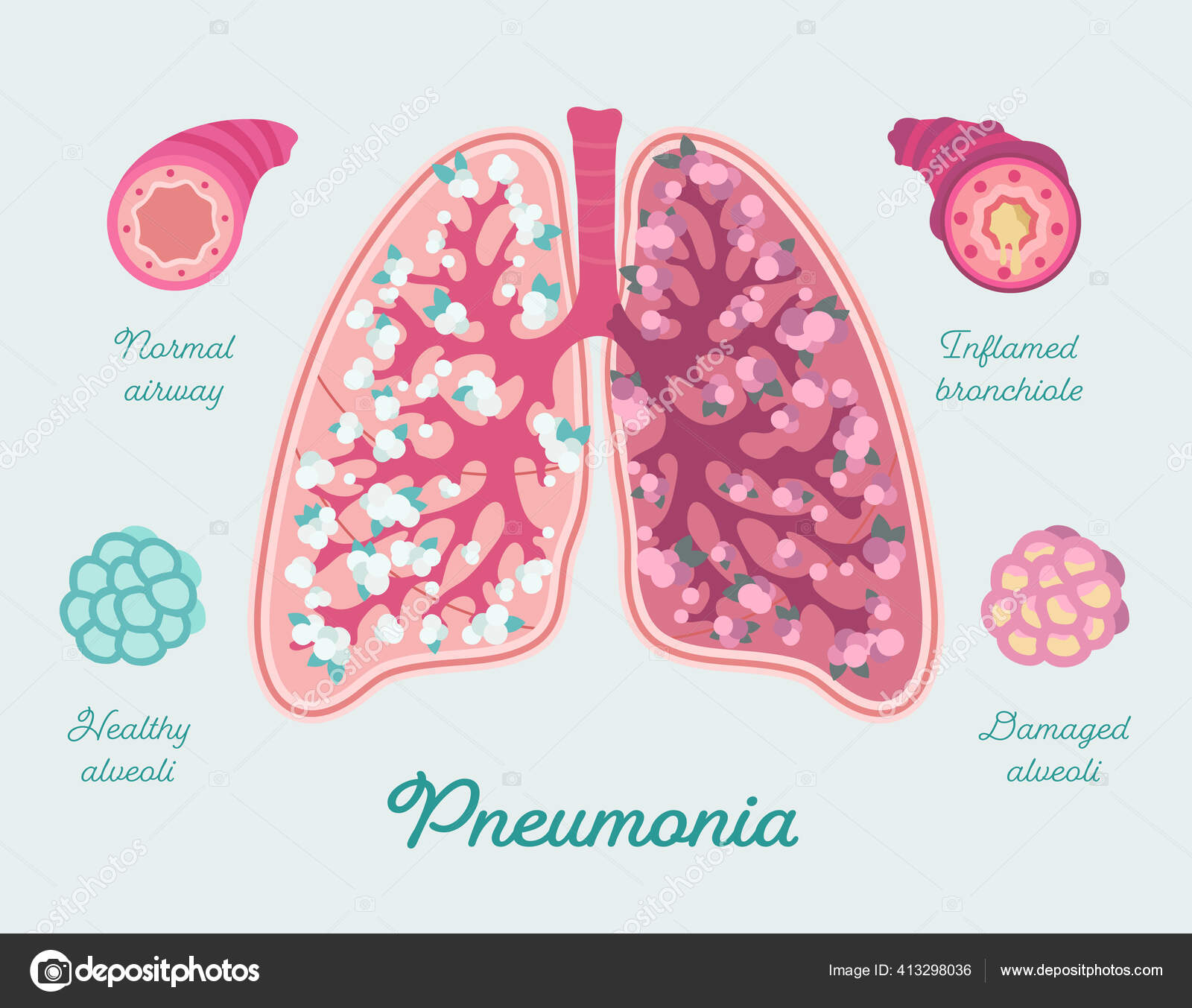 Pneumonia in human lungs. Inflammation lungs - including due to COVID ...