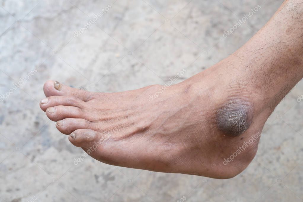 Primer plano del pie con una infección de los pies causada por hongos. 2023