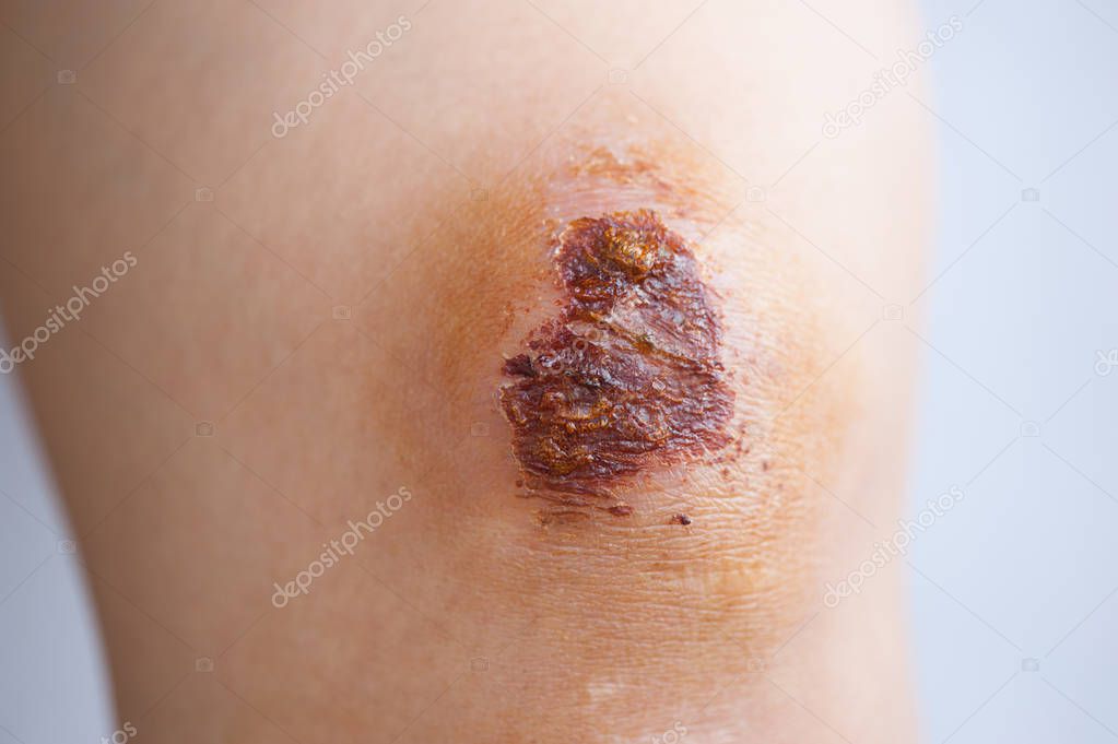 Cicatriz y costra (eschar) en la rodilla femenina asiática 2022