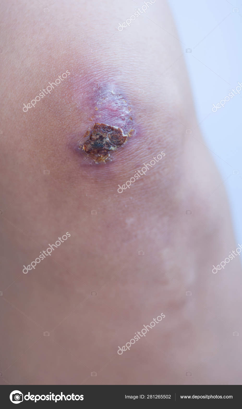 Scar Scab Eschar Asian Female Knee — Stock Photo © lzf #281265502