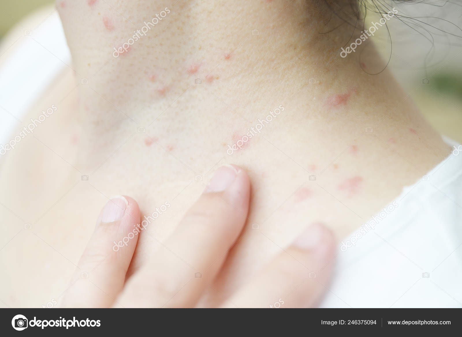 Woman Having Skin Problems — Stock Photo © liza5450 #246375094