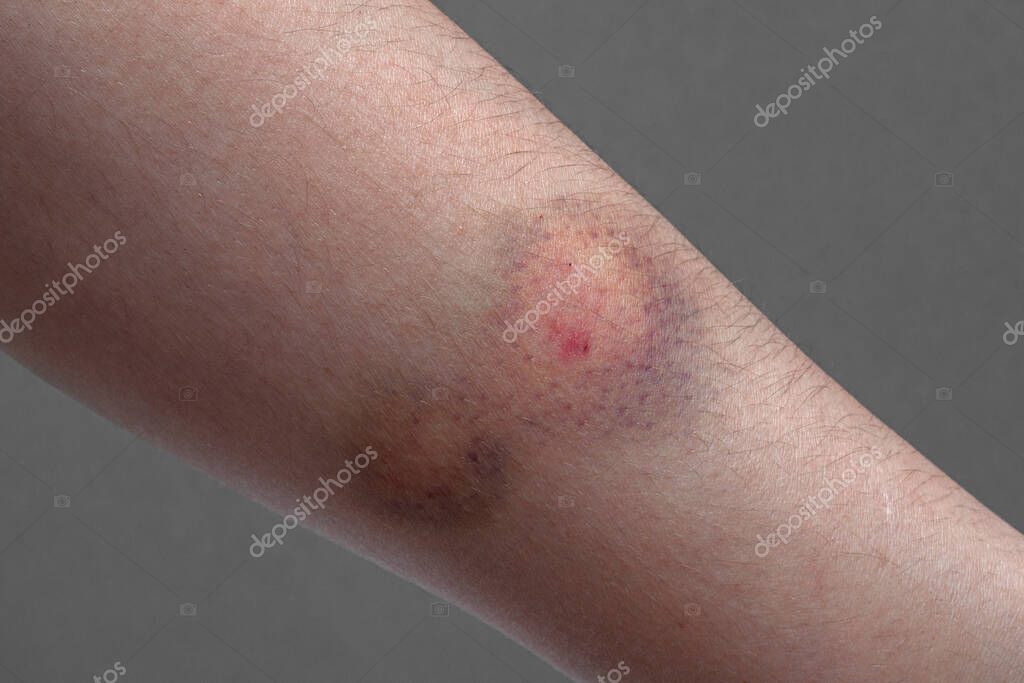 Acercamiento de un moretón de color en un brazo de mujer. 2023