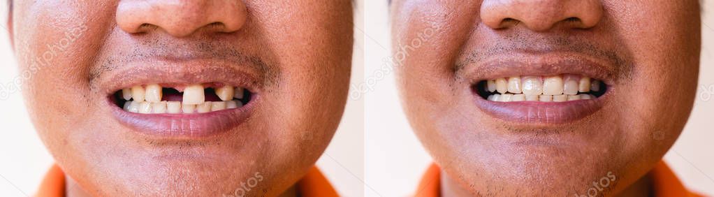 ᐈ Men with missing teeth stock pictures, Royalty Free missing teeth man ...