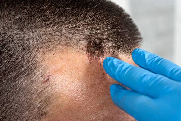 Scalp scab Stock Photos, Royalty Free Scalp scab Images | Depositphotos