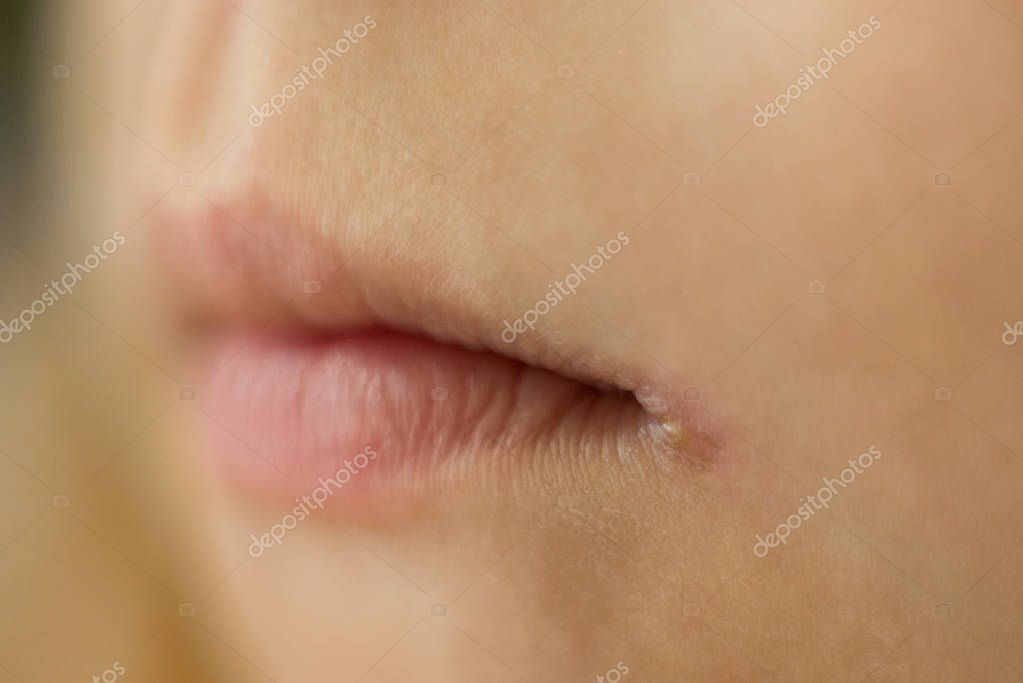 problemas de la piel, angulitis, estomatitis angular, queilitis angular ...