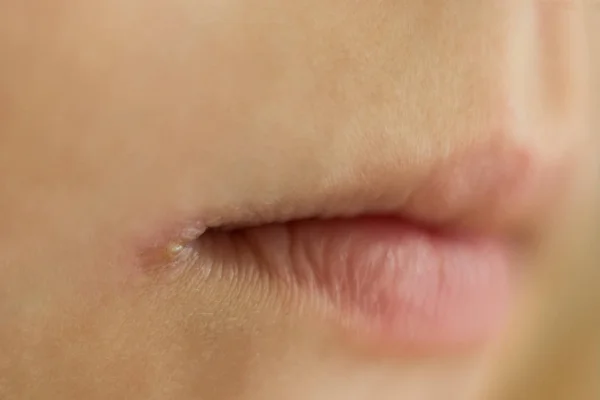 problemas de la piel, angulitis, estomatitis angular, queilitis angular ...