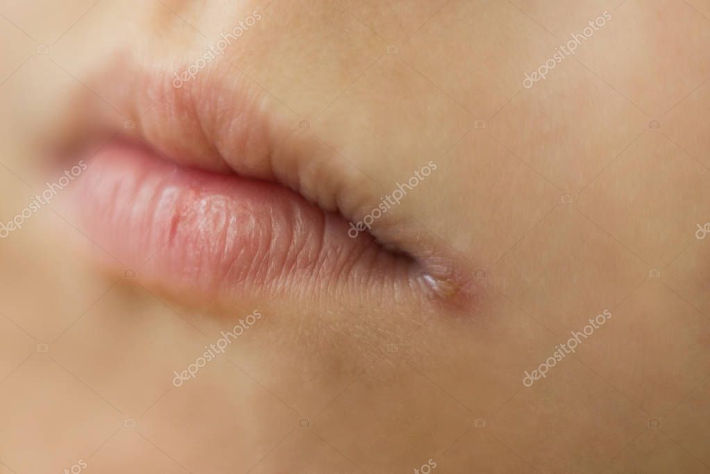 problemas de la piel, angulitis, estomatitis angular, queilitis angular ...