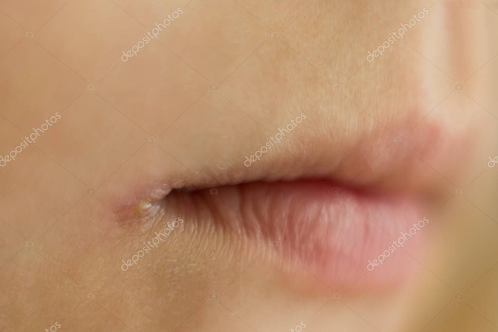 problemas de la piel, angulitis, estomatitis angular, queilitis angular ...