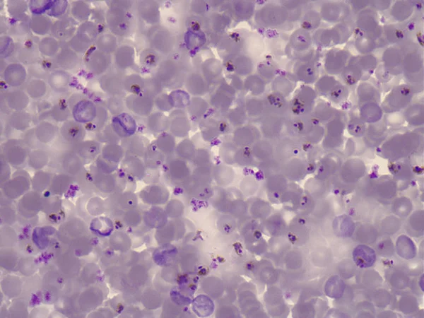 Infectious Mononucleosis Blood Smear