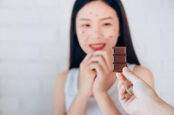 Young Asian Woman Acne Problem Face with Chocolate bar but Happy Eating ...
