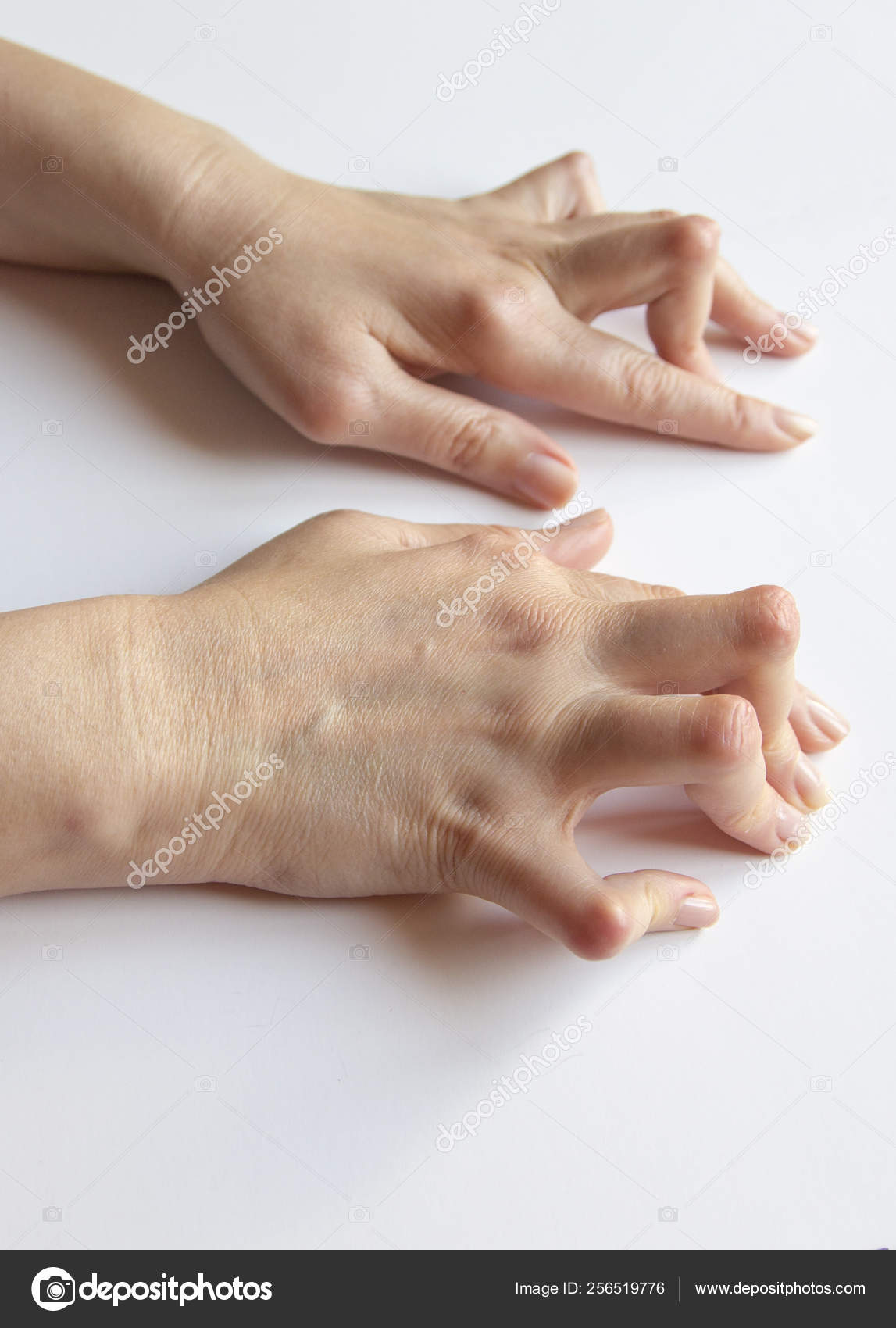 Revmatoid Artritt Hender Revmatoid Artritt Nordimet® Allmennheten