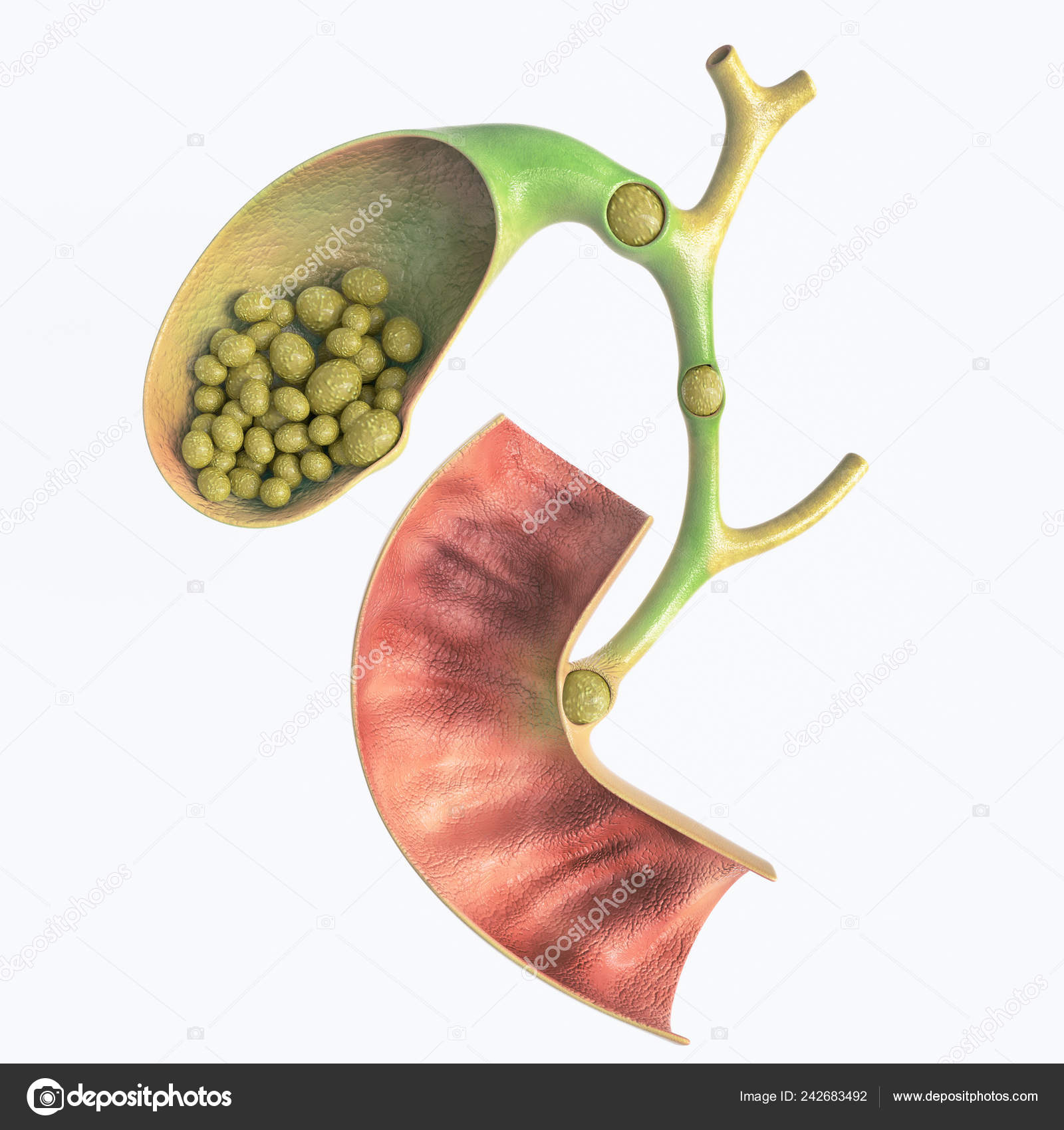 Gallstones Gallbladder Bile Duct High Details Rendering Stock Photo by ...
