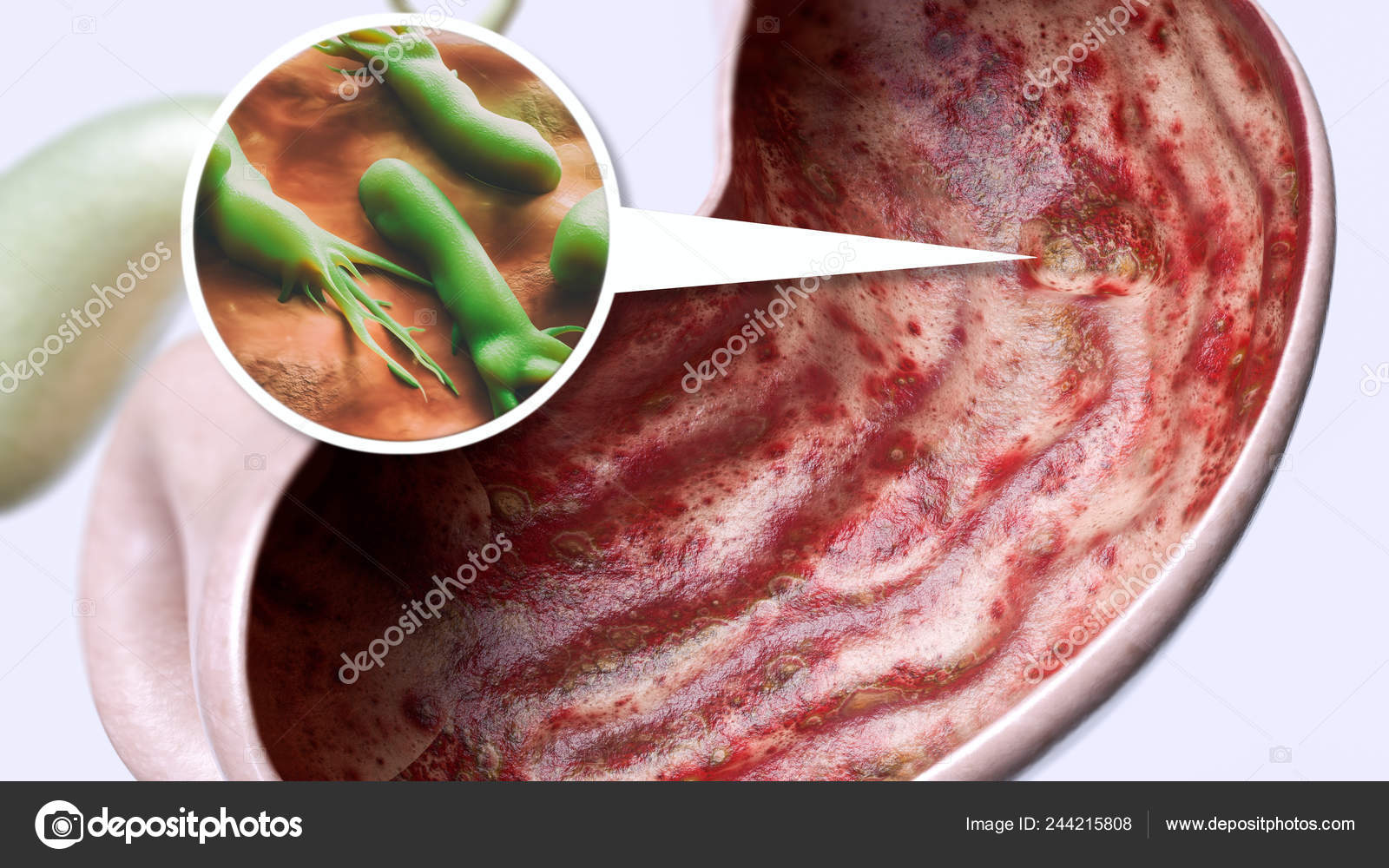 Gastric Ulcer Helicobacter Pylori High Degree Detail Rendering — Stock ...