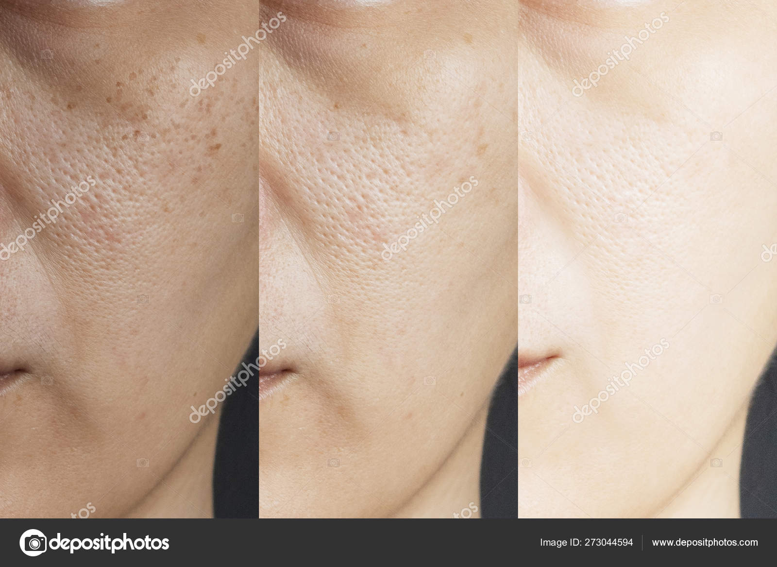 Dull Skin Before After