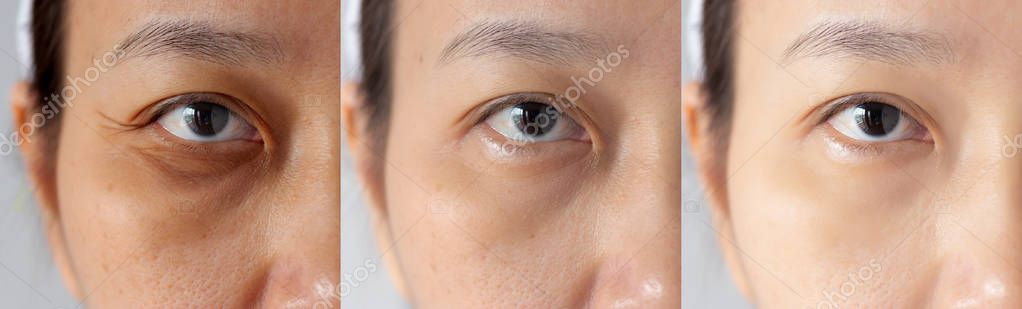 tres imágenes compararon efecto antes y después del tratamiento. bajo ...