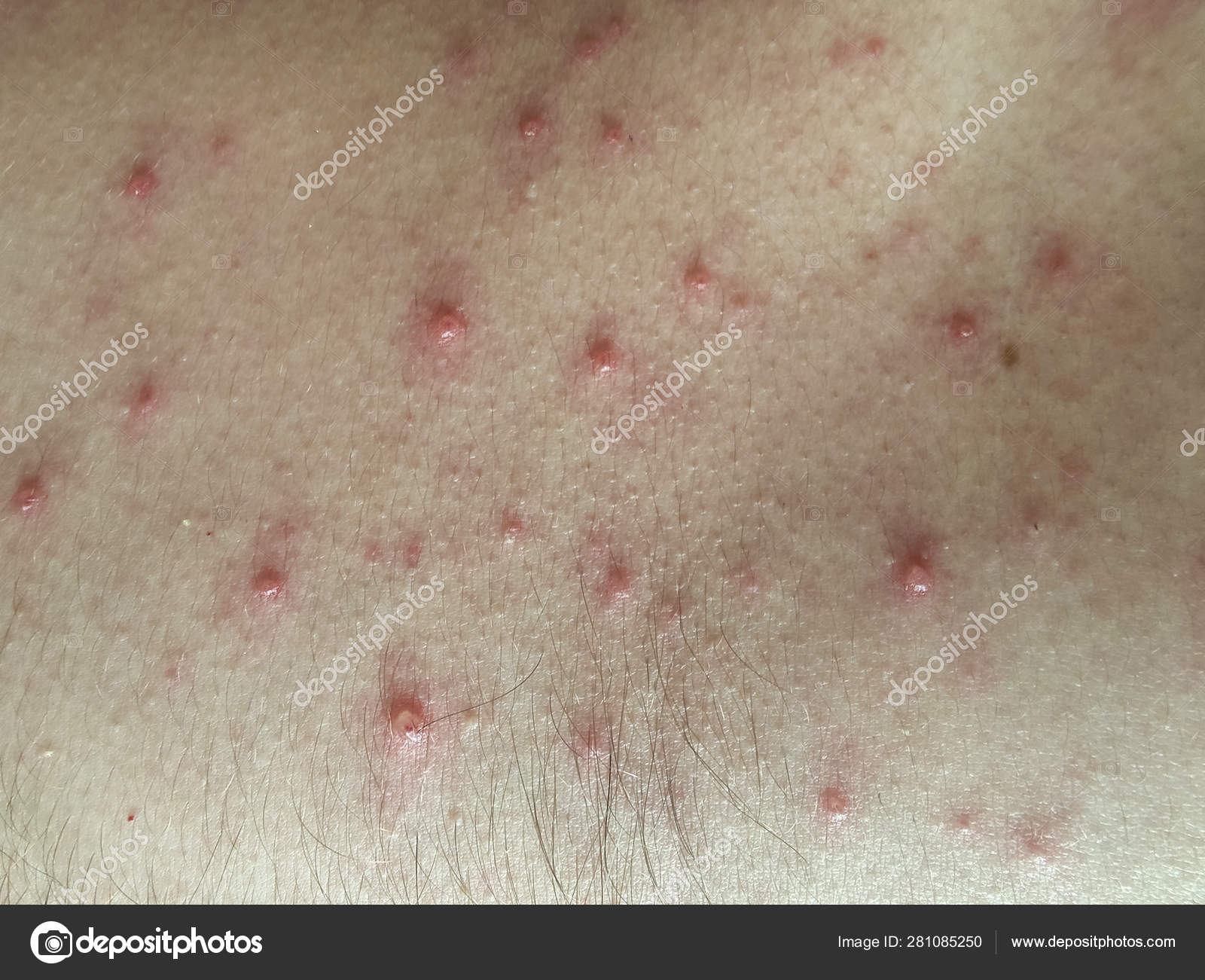 Chicken pox rash on the body.Chickenpox is an infection caused by the ...