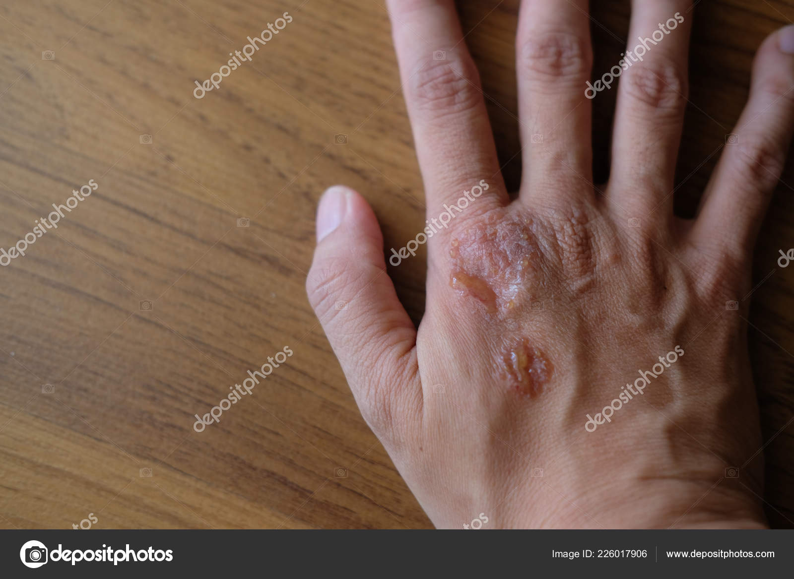 Psoriasis Vulgaris Fungus Eczema Female Hand Pus Rash Dermatological