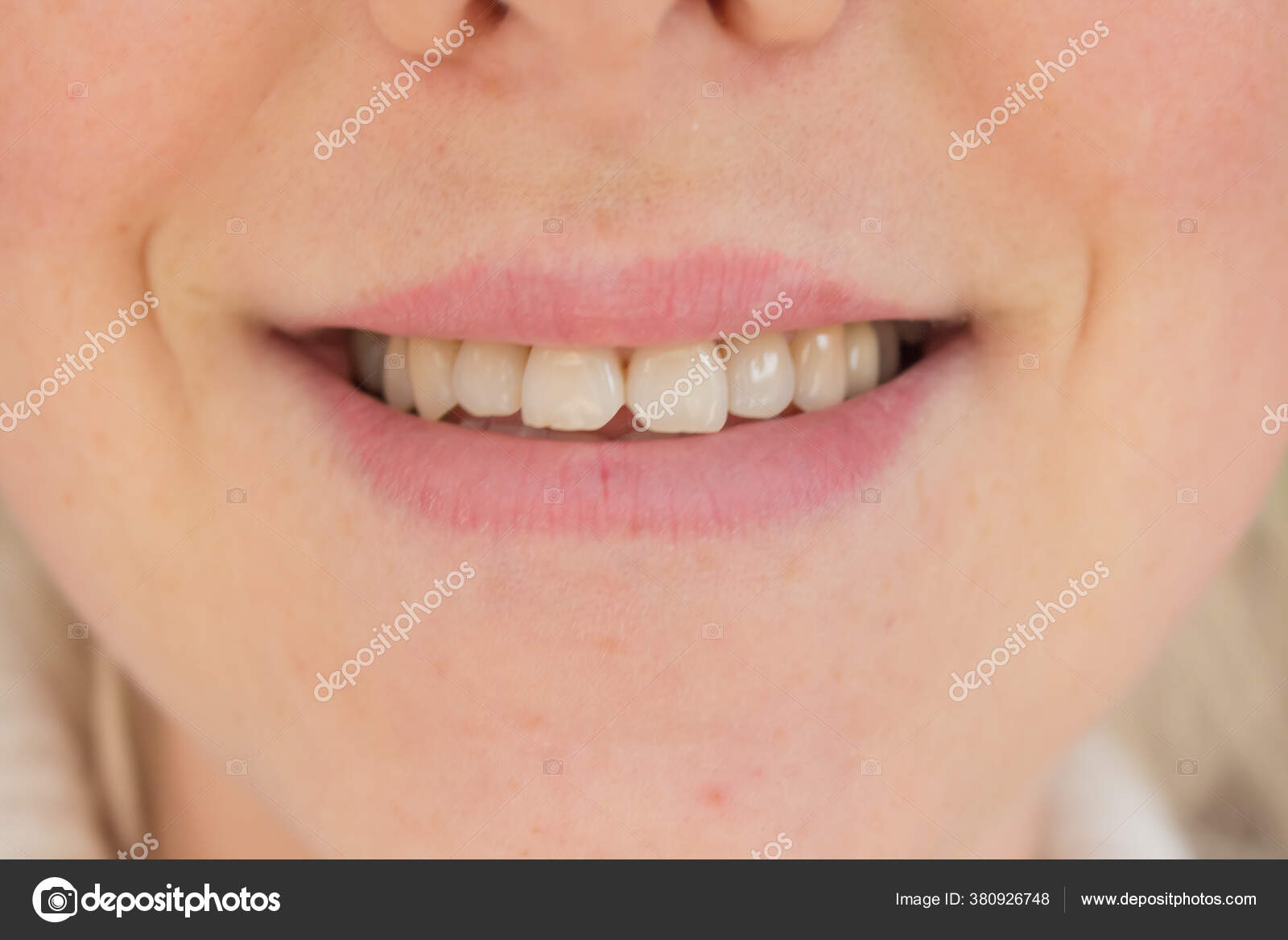 Chips on the front teeth. concept of dentistry and oral hygiene Stock ...