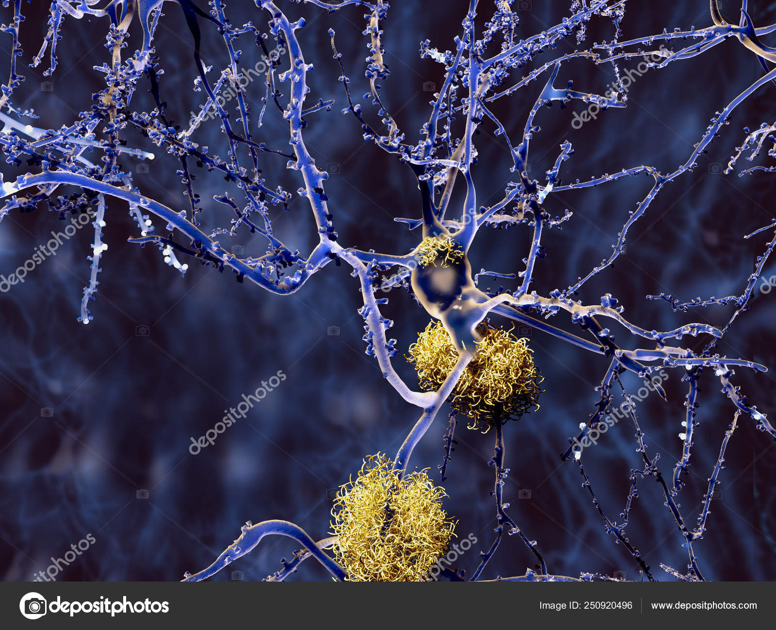 Alzheimer Disease Neuron Amyloid Plaques Illustration — Stock Photo ...
