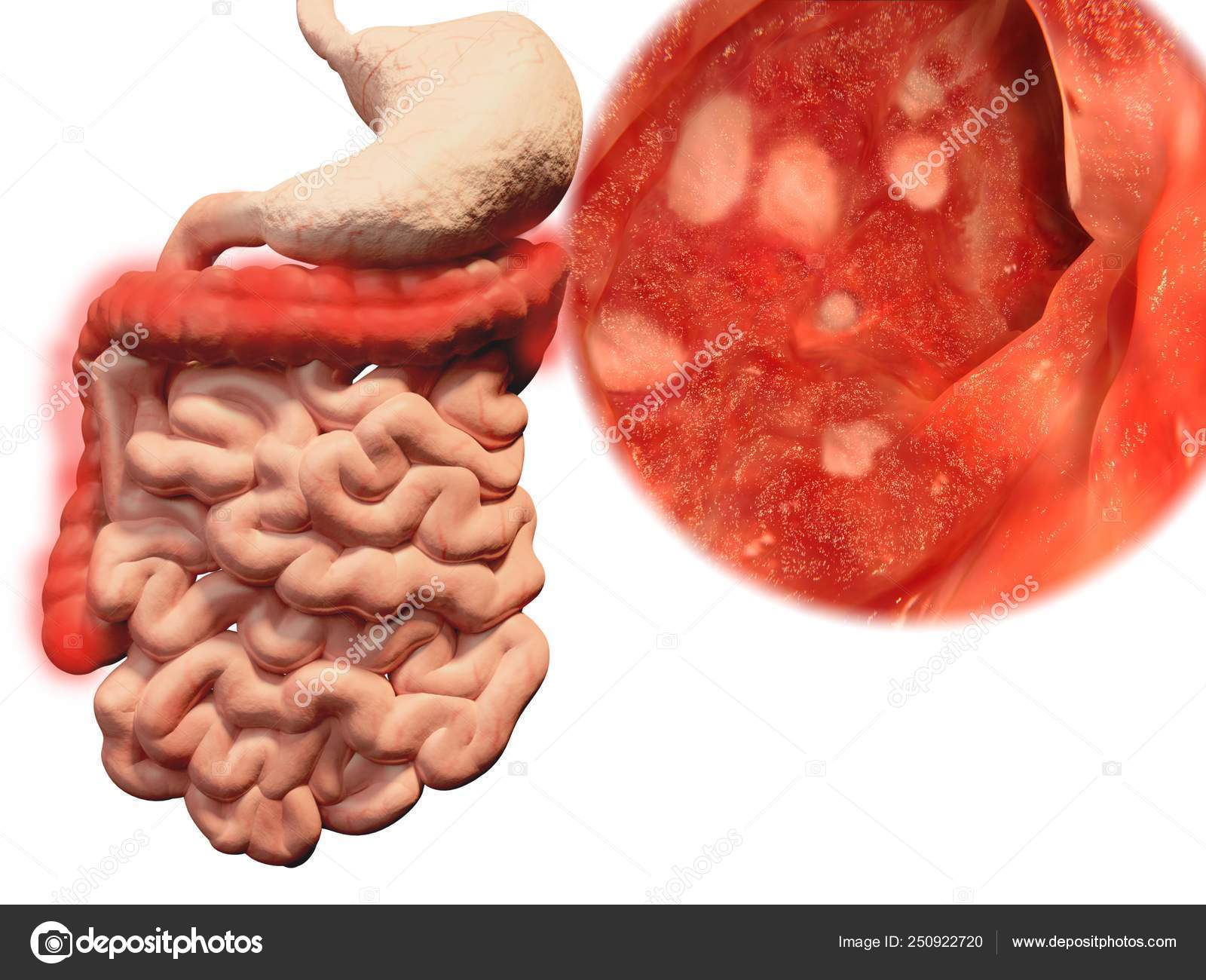 Ocorrência Colite Ulcerosa Trato Gastrointestinal Ilustração fotos ...