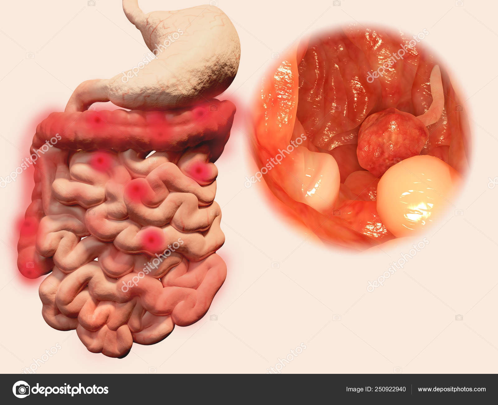 Polyps Gastrointestinal Tract Illustration Stock Photo by ©animaxx3d ...