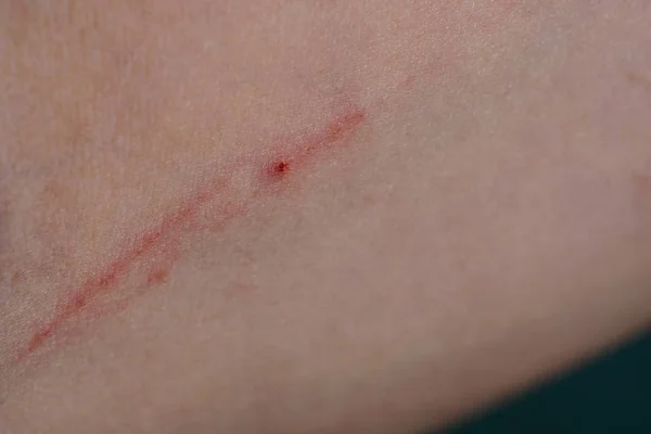 Scratch wound Stock Photos, Royalty Free Scratch wound Images ...