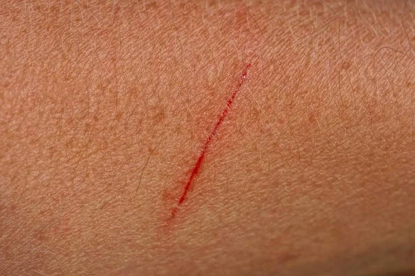 Scabs Stock Photos, Royalty Free Scabs Images | Depositphotos