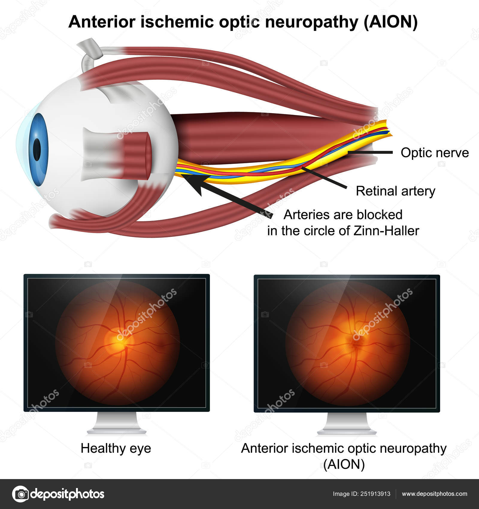 Ishemic Optic Neuropathy Medical Vector Illustration White Background ...