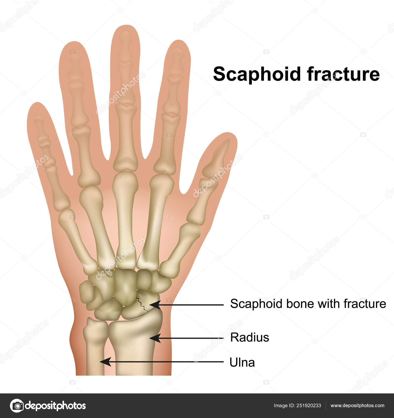 Scaphoid Bone Fracture Medical Vector Illustration White Background ...
