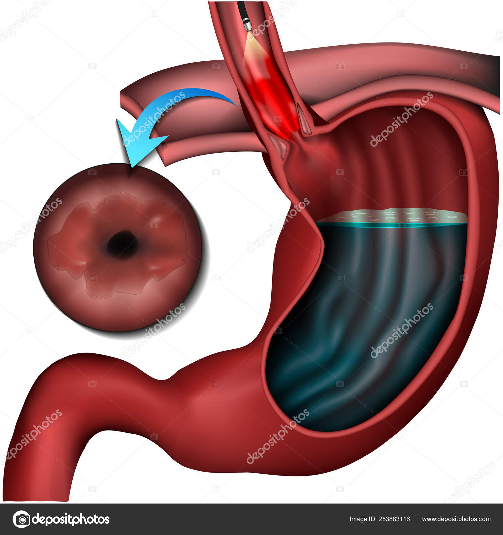 Barett Esophagus Disease Medical Vector Illustration White Background ...