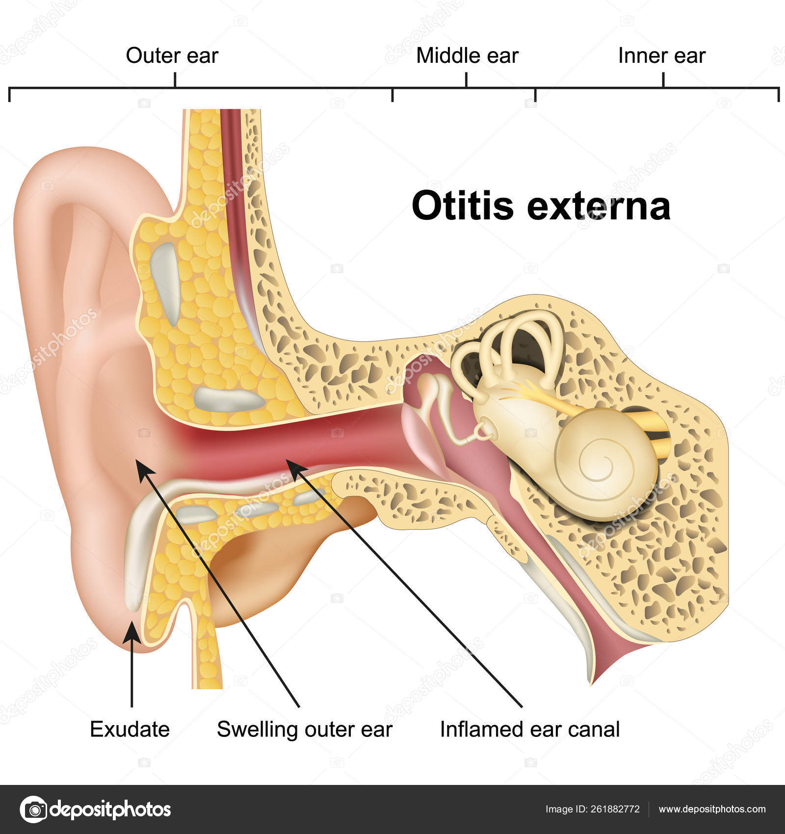 Otitis Externa Ear Disease Medical Vector Illustration White Background ...
