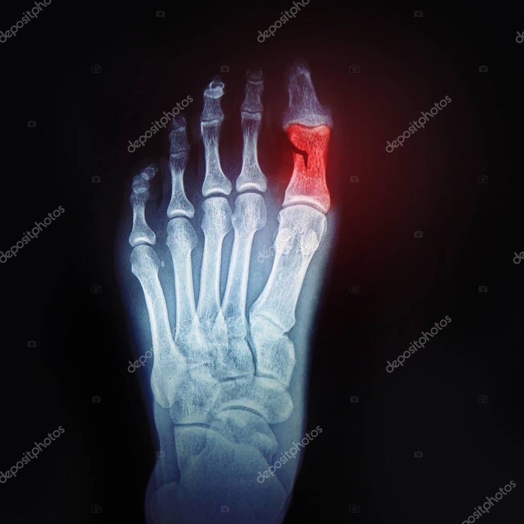 Un dedo roto. Radiografía del pie con la designación del punto dolorido ...